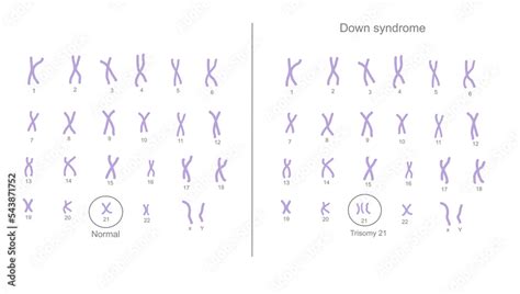 Down Syndrome Chromosomes And Normal Chromosomes