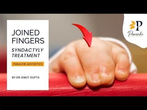 Syndactyly Webbing Release Of Fingers Congenital Syndactyly
