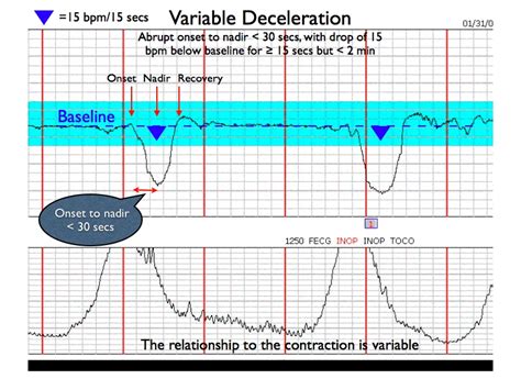 Basic Pattern Recognition Electronic Fetal Monitoring