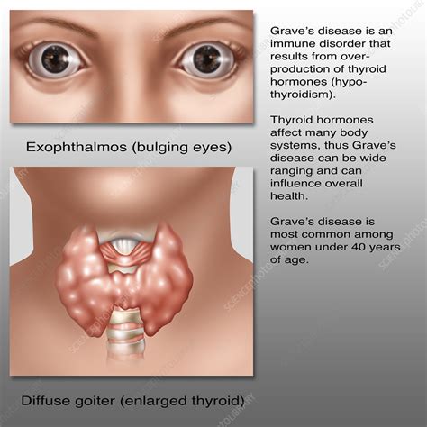 Graves Disease Associated With Exophthalmos Cerebral Thyroid Eye