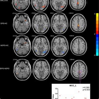 Statistical Parametric Map Showing The Significant Differences In The Download Scientific