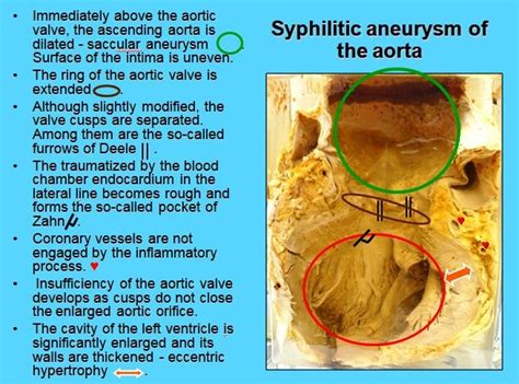 Aortic Aneurysm Causes Symptoms Treatment Zdrave Bgeu