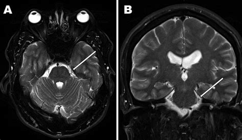 Axial A And Coronal B T2 Fat Saturation Mri Showing The Left