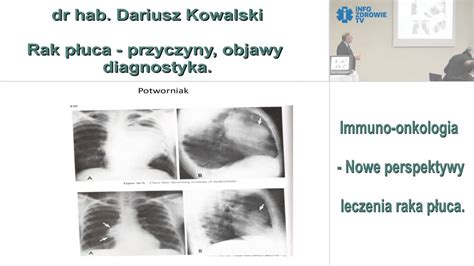 Rak P Uca Przyczyny Objawy Diagnostyka Youtube Hot Sex Picture