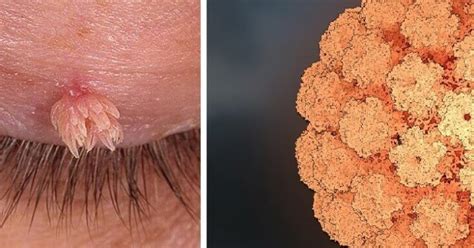 როგორ მოვიშოროთ პაპილომები სწრაფად და უმტკივნეულოდ