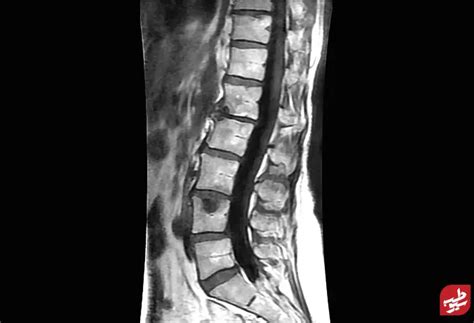 روش خواندن عکس ام ار ای از دیسک کمر؛ مرحله به مرحله بخوانید