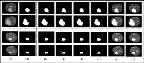 Figure 4 From Edge Enhancement Based On An Active Contour Model For The Segmentation Of Brain