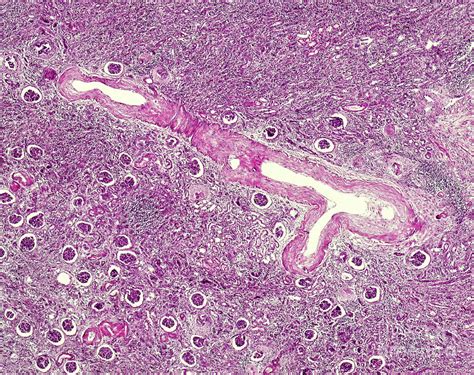 Cresentic Glomerulonephritis Photograph By Nigel Downer Science Photo Library Pixels