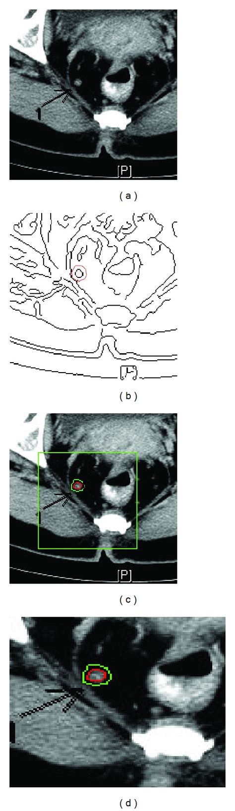 single lymph node segmentation a original image b edge map we