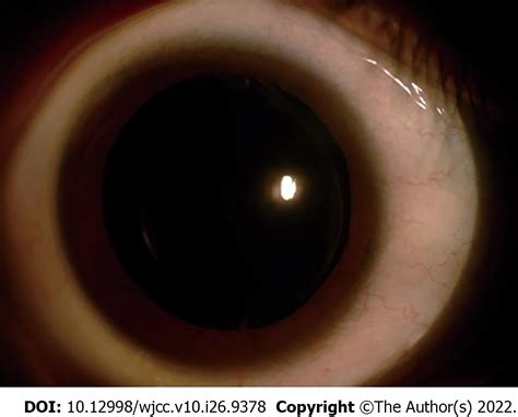 Bilateral Hypocalcaemic Cataracts Due To Idiopathic Parathyroid Insufficiency A Case Report