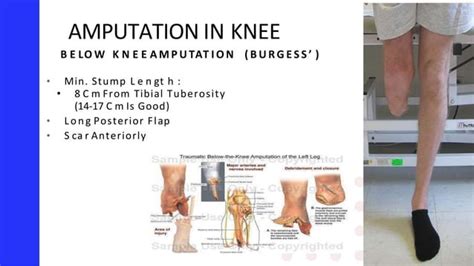 Knee Amputation Pptx