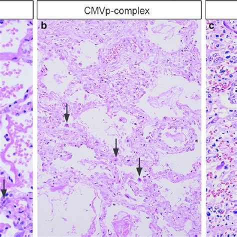 A Schema For Pathogenesis Of Cytomegalovirus Cmv Pneumonia Cmvp