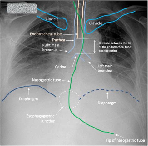 The Accuracy Of Intensive Care Nurses Interpretation Of Chest
