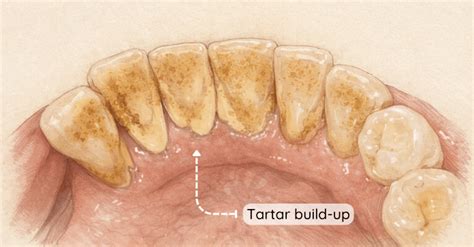 How To Remove Tartar At Home What You Can — And Cant Do Share