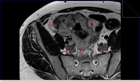 Cecal Tumor Mri Radiology Article On Cecal Carcinoma