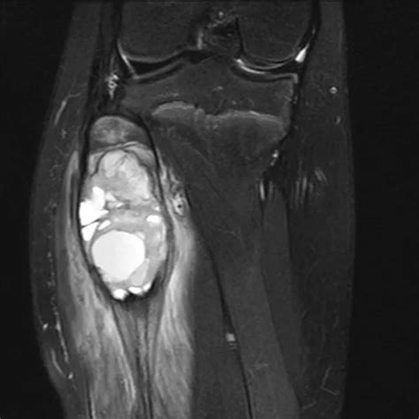 Aneurysmal Bone Cyst Imaging Case 1