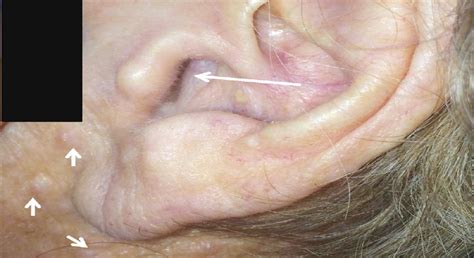 Symptoms Ear Plugging And Hearing Loss The Hearing Journal