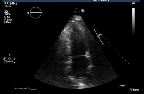 Echocardiography Showed Normal Left Ventricular Function With No Download Scientific Diagram