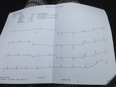 Ecg Team Jo Epilepsy Foundation
