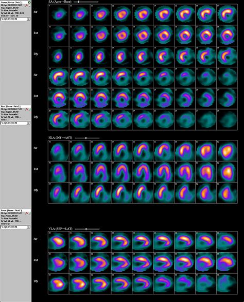 Nuclear Medicine Scan Heart