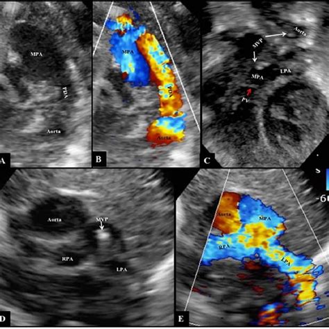 Relative Incidence Of Pda Types A Relative Incidence Of Pda Types Download Scientific
