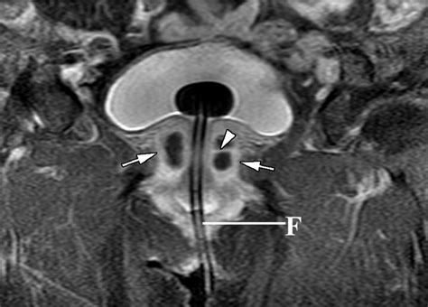 Imaging Of Female Urethral Diverticulum An Update RadioGraphics