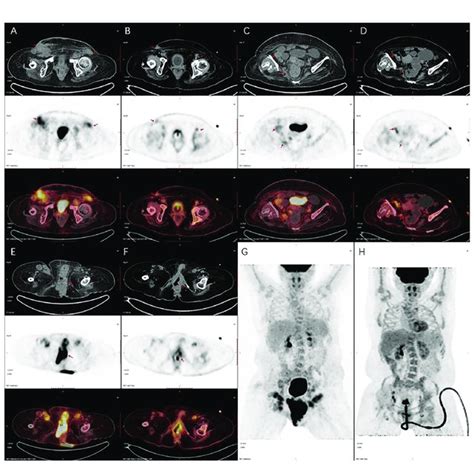Pathophysiology Of Usual Type And Differentiated Vin And Its