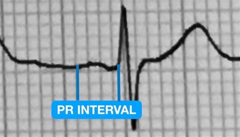 Ecg Segments And Intervals — The Pr