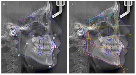 Craniofacial Morphology Of Temporomandibular Disorder Patients With