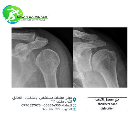 خلعالكتف هو إصابة تخرج فيها عظام الذراع العلوية من التجويف الذي يأخذ