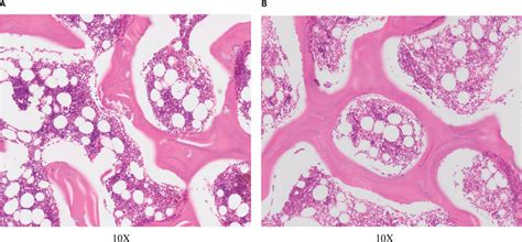 He On Day 0 A Normal Vertebra B Radiofrequency Ablation Zone Download Scientific Diagram