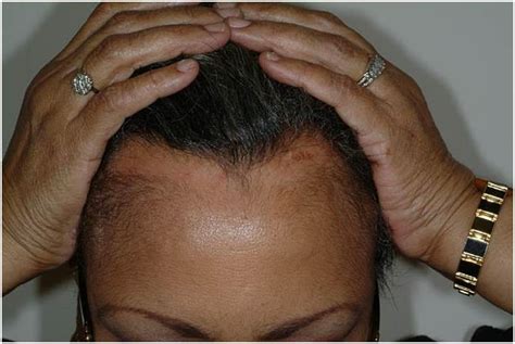 Frontal Fibrosing Alopecia Download Scientific Diagram