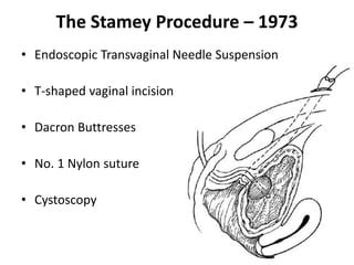 Urinary Incontinence In Females Operative Pptx