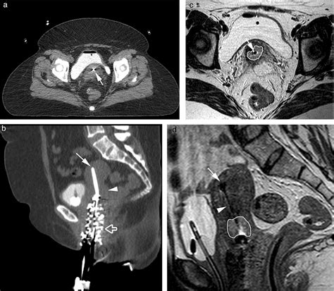 Magnetic Resonance Imaging For Planning Intracavitary Brachytherapy For
