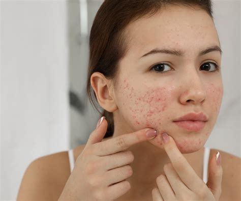 טיפול באקנה להיפטר מהפצעים וליהנות מעור בריא בטא ישראל