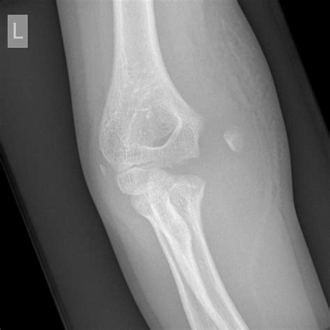 Medial Epicondyle Fractures Pacs
