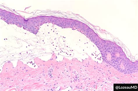 Pemphigoid Histology