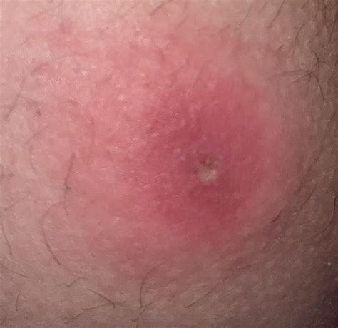Mrsa Acne R Mrsa