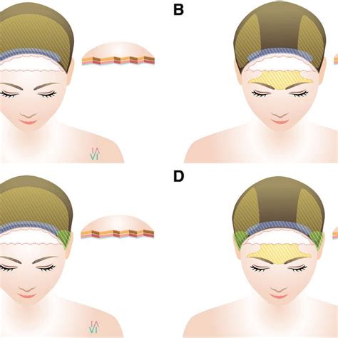 Flap Dissection Layer And Area A Group I B Group Ii C Group