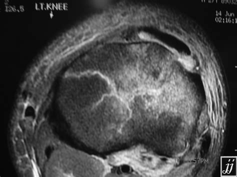 Bankart Lesion Radiopaedia