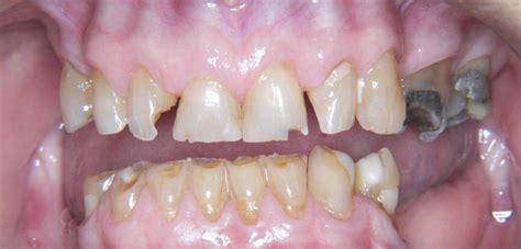 Missing Teeth And Their Consequences French Dental Services Dubai