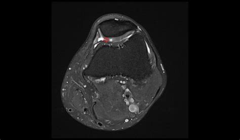 Chondromalacia Mri Radiology Article On Chondromalacia Patellae