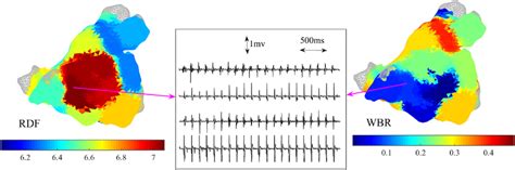 Example Of 3 Dimensional Atrial Maps Color Coded Based On The Regional