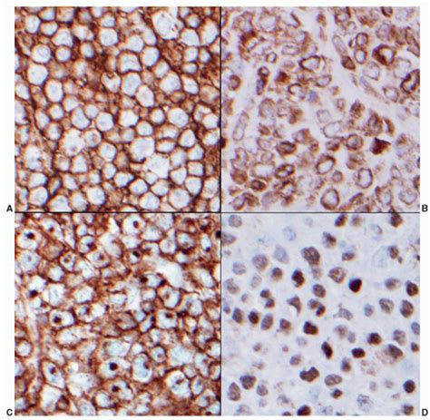Diagnosis And Classification Of Lymphomas Oncohema Key