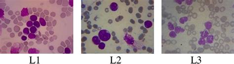 Figure 1 From Identification Of Acute Lymphoblastic Leukemia Subtypes