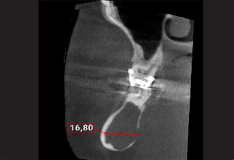 Preoperative Cone Beam Computed Tomography Showing Measurement Of ≈ 17 Download Scientific