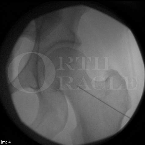 Hip Injection Using Image Intensifier Surgical Technique Orthoracle