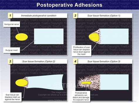 Postoperative Adhesions