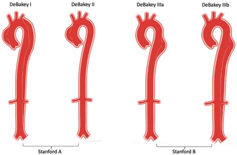 Debakey And Stanford Aortic Dissection Classification Download Scientific Diagram