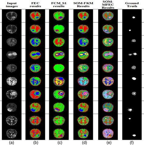 Segmentation Outcomes Of High‐grade Carcinoma In Brats Dataset Brain Mr
